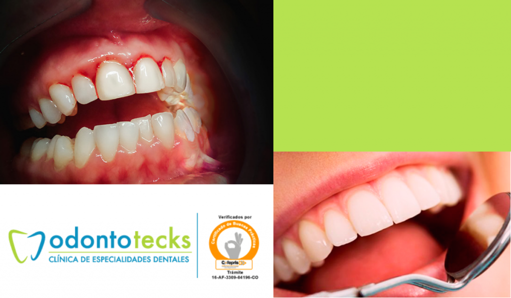 Dientes flojos, causas y consecuencias | Odontotecks