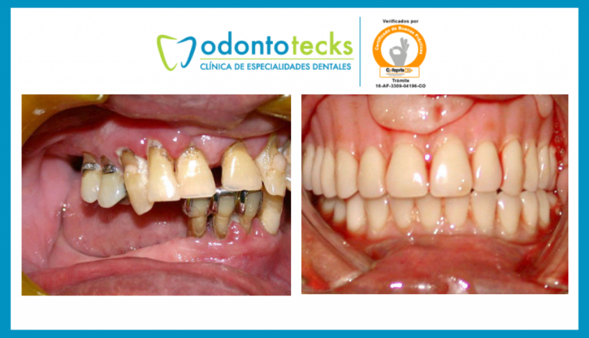 Regularización alveolar | Odontotecks