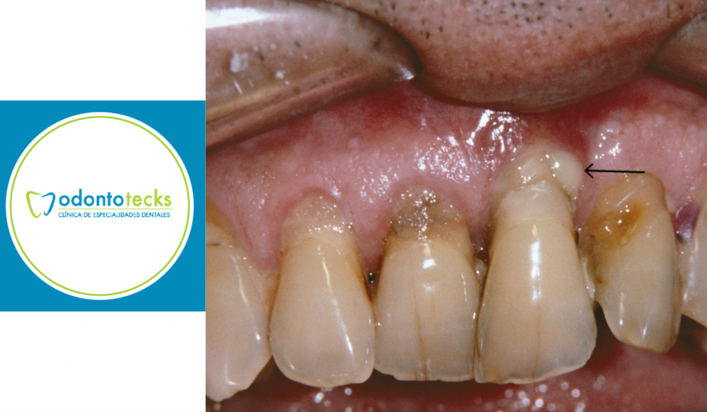 Periodontitis: síntomas y causas | Odontotecks