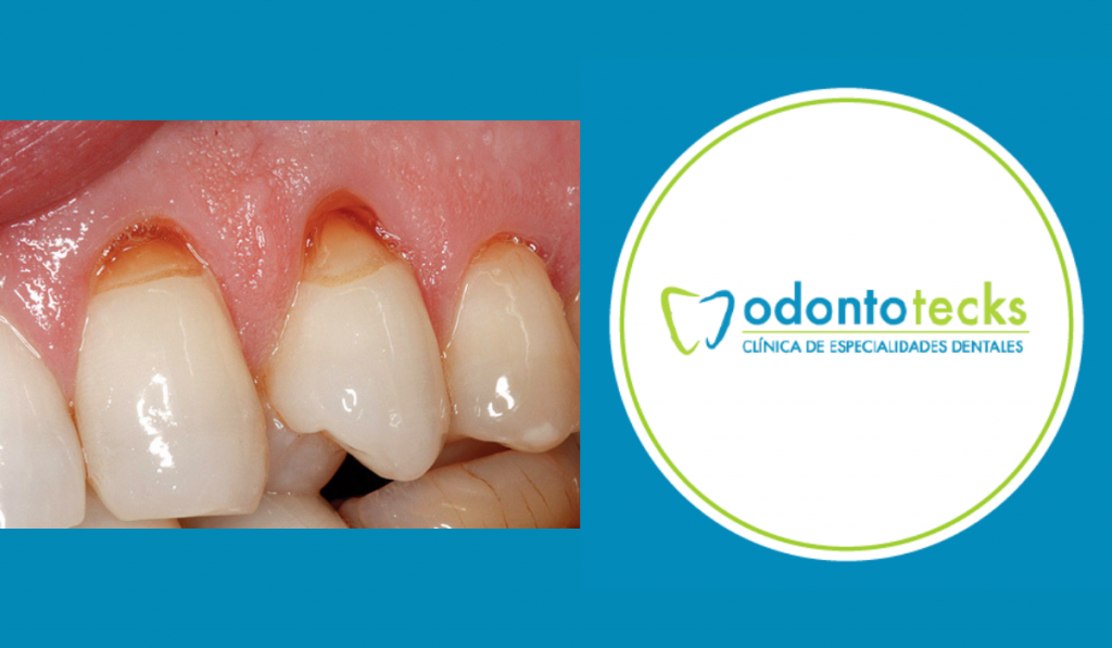 Abfracción dental: ¿qué es? | Odontotecks