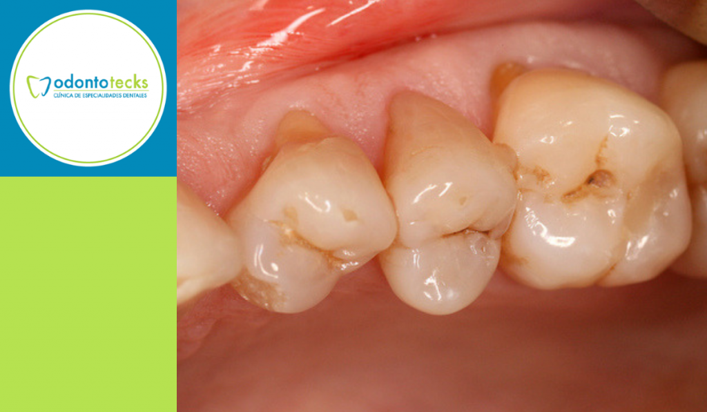 Caries dentales, ¿cómo prevenirlas? | Odontotecks